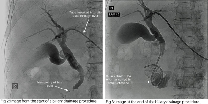 Biliary Drainage - InsideRadiology