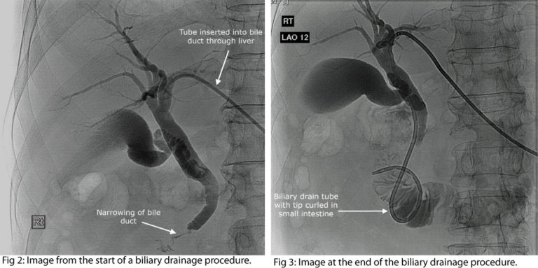 Biliary Drainage - InsideRadiology